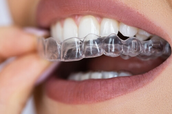 How Much Does Invisalign Cost? A Comprehensive Guide